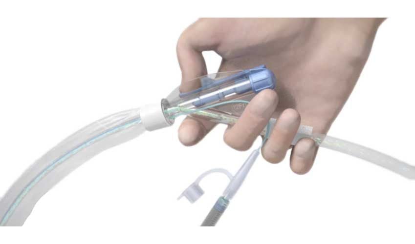 SuctionPro72 | Portex Smith's Medical Z115N-14, Z110N-14, Z115-14 ...