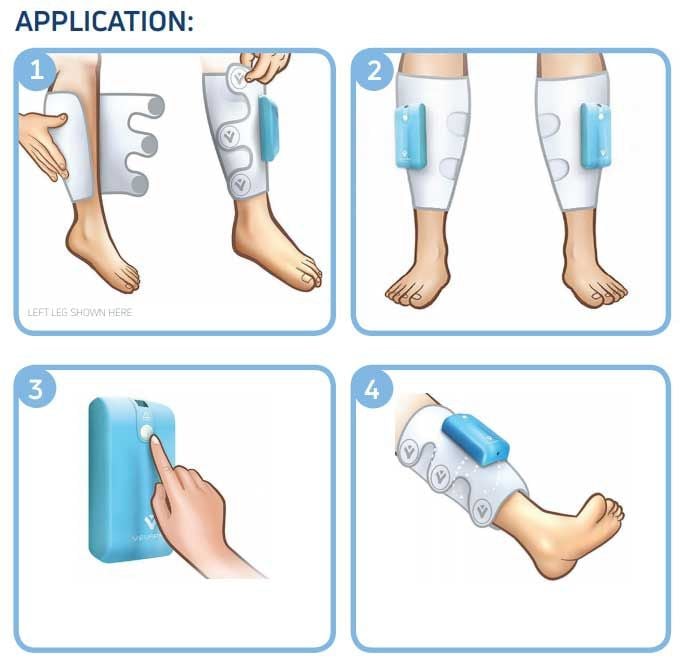 Sequential Compression Device