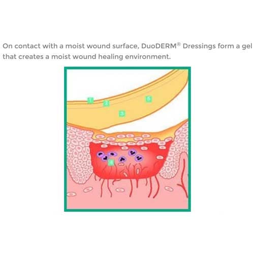 DuoDERM Extra Thin CGF Dressing | All Sizes | Vitality Medical