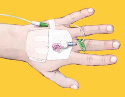 4973 OpSite IV3000 1-Hand 4 x 5-1/2 Inch Dressing BUY Central/Jugular ...