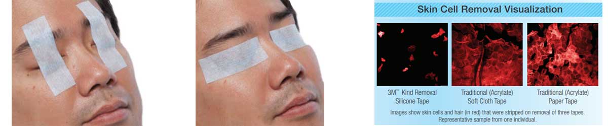Buy 3M Kind Removal Silicone Tape - All Sizes | Vitality Medical